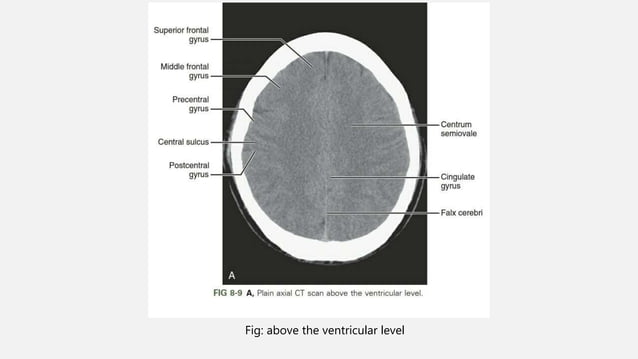 Ncct and cect brain and orbit | PPTX | Blood Disorders | Diseases and ...