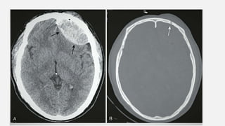 Ncct and cect brain and orbit | PPTX