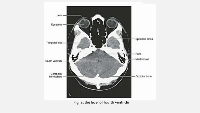 Ncct and cect brain and orbit
