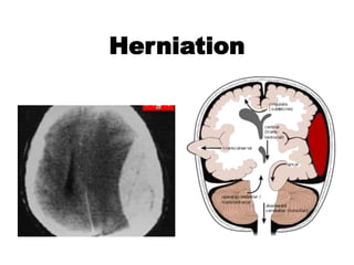 Nc head and spinal trauma | PPT