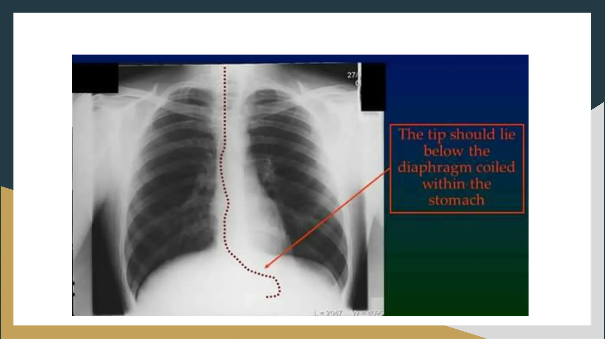 TOPICS TPN (Total Parenteral Nutrition)I Nasogastric Tube Insertion ...