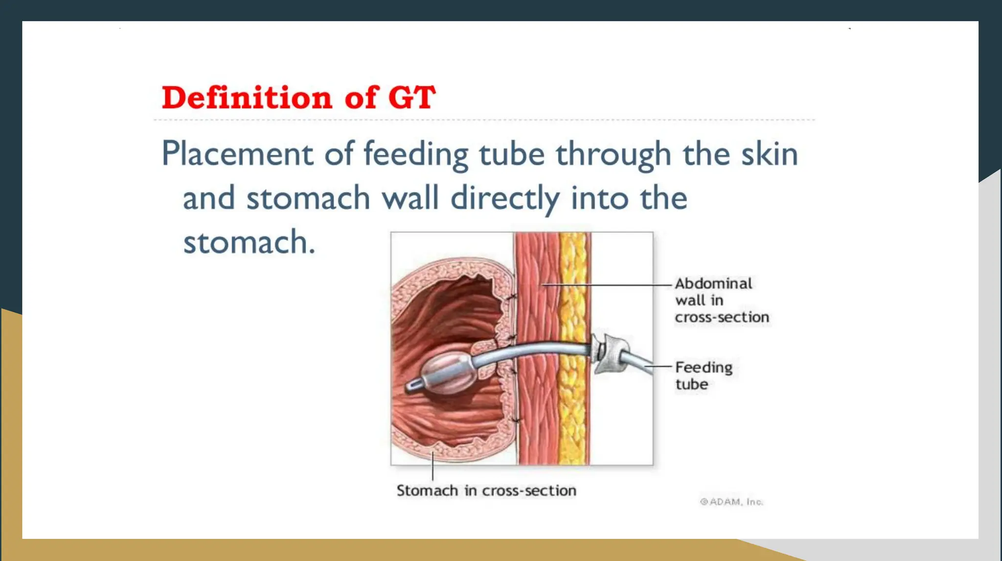 TOPICS TPN (Total Parenteral Nutrition)I Nasogastric Tube Insertion ...