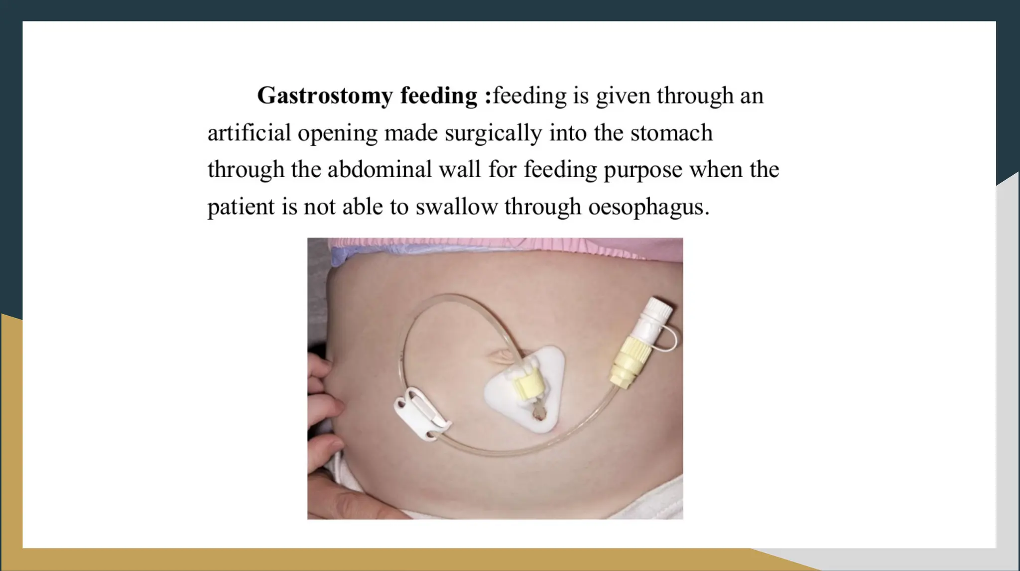 TOPICS TPN (Total Parenteral Nutrition)I Nasogastric Tube Insertion Nasogastric Tube Feeding ...