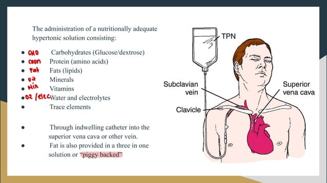TOPICS TPN (Total Parenteral Nutrition)I Nasogastric Tube Insertion ...