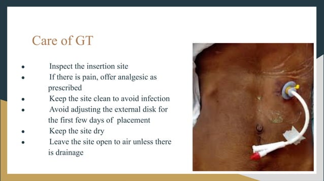 TOPICS TPN (Total Parenteral Nutrition)I Nasogastric Tube Insertion ...