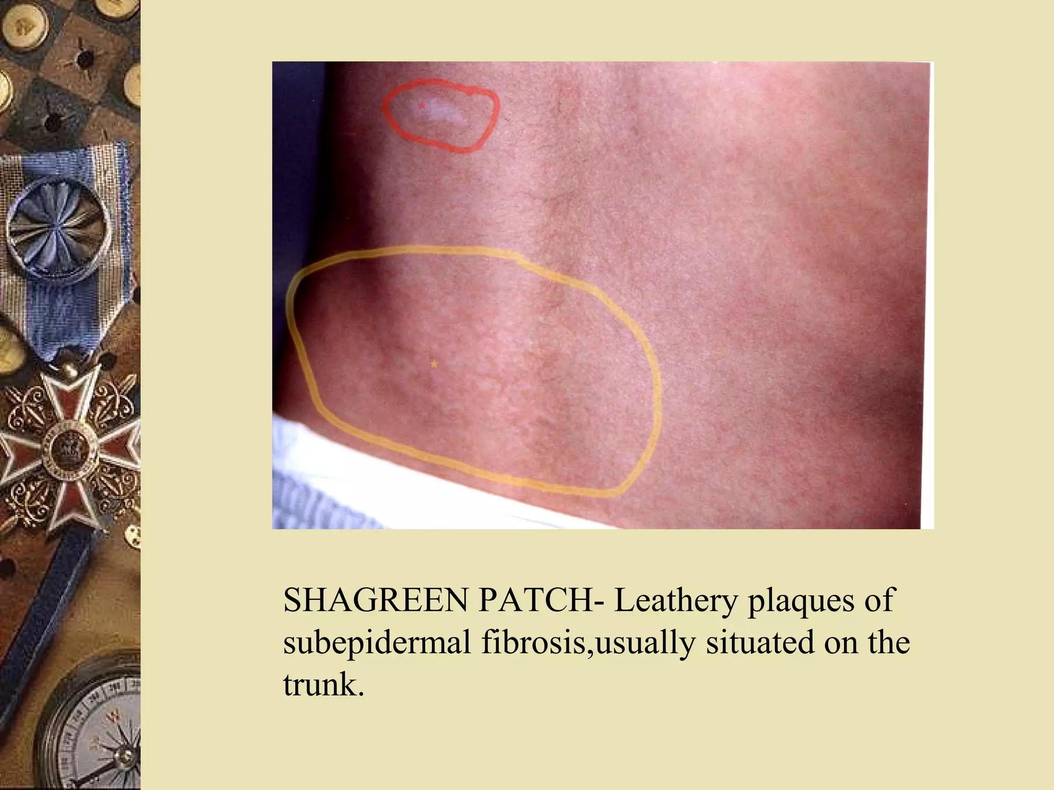 neuro cutaneous markers | PPT