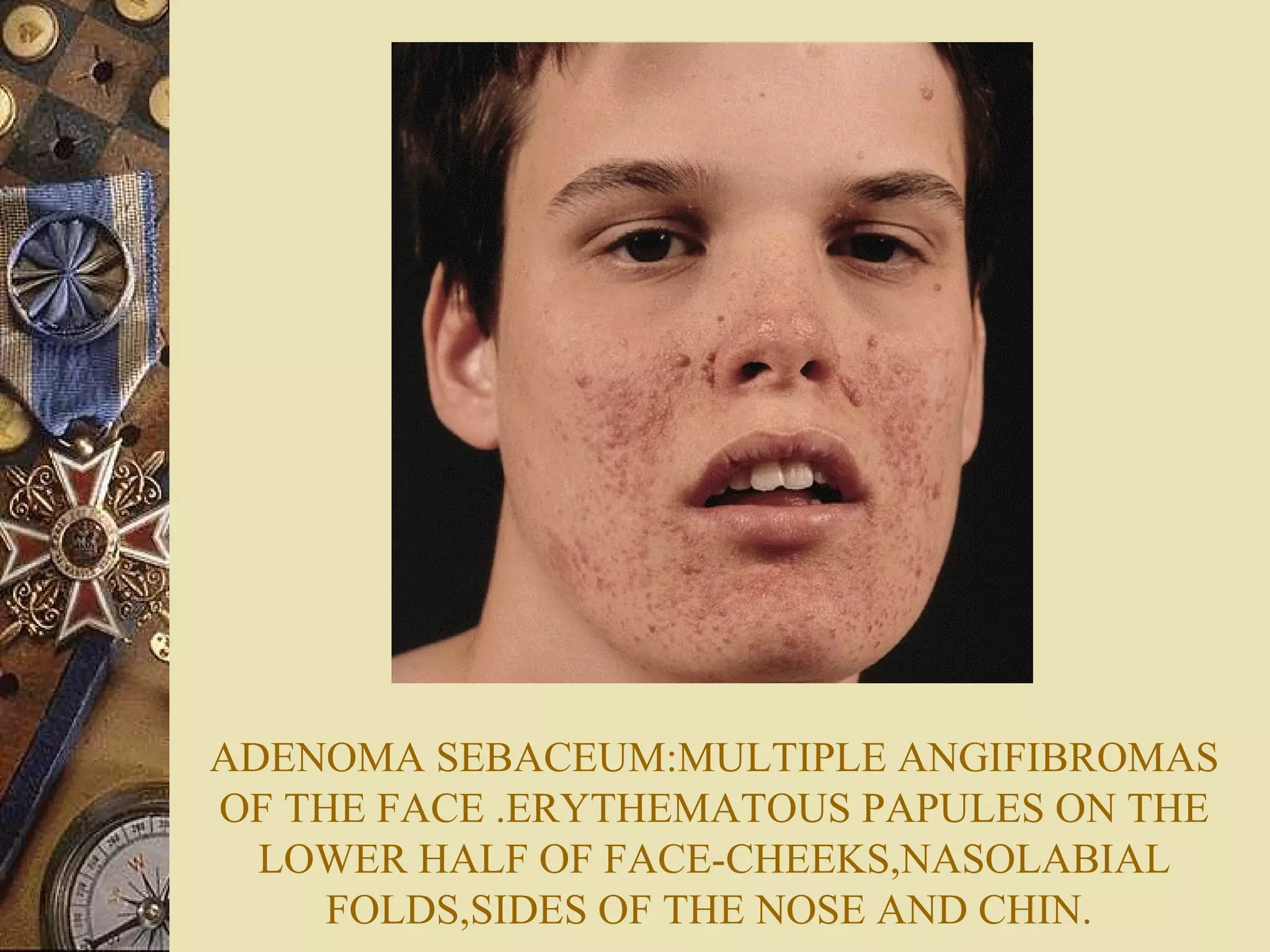 neuro cutaneous markers | PPT