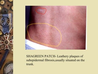 neuro cutaneous markers | PPT