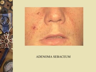 neuro cutaneous markers | PPT