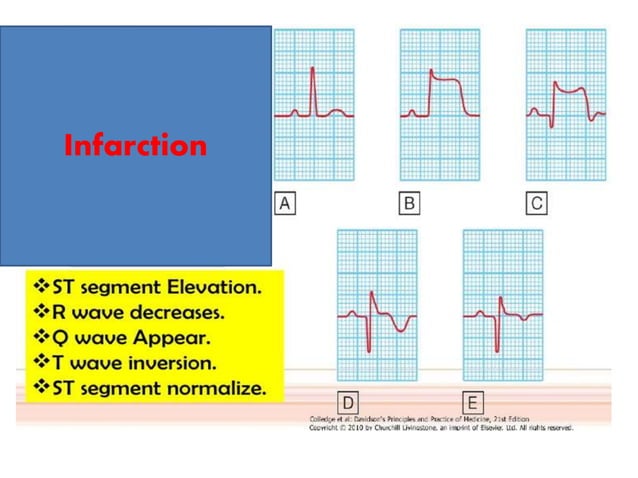Chest Pain : Immediate Nursing Interventions | PPTX | Heart and ...
