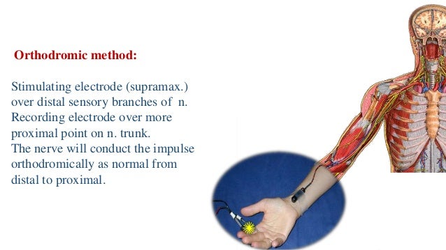 Nerve conduction studies