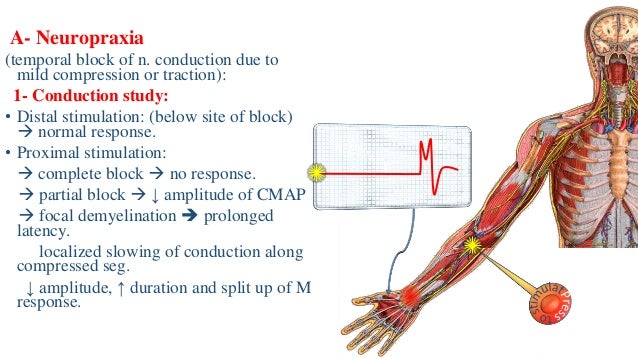 Nerve conduction studies