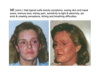 Morgellons Face Treatment