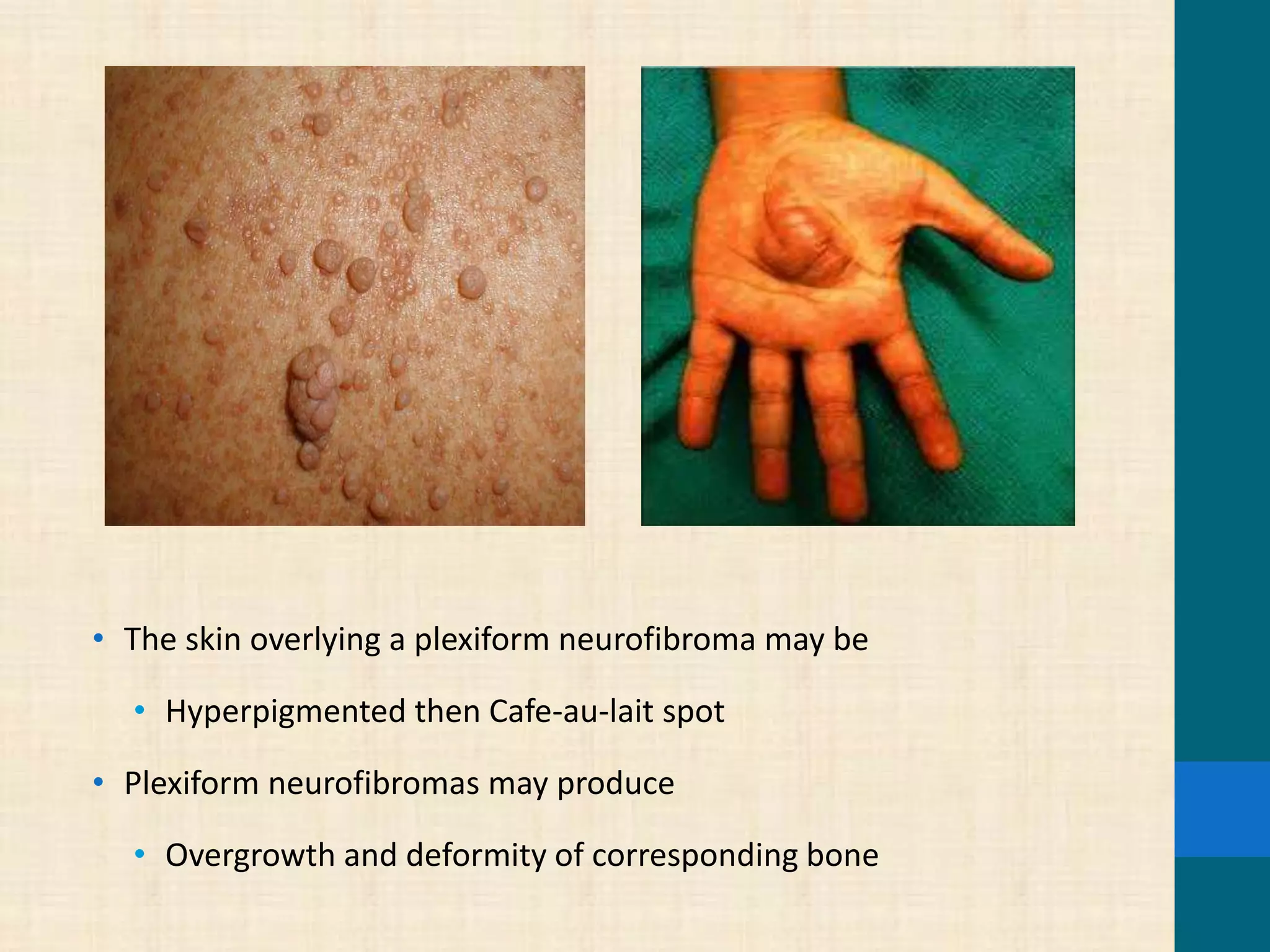 NEUROCUTANEOUS SYNDROME | PPTX