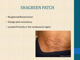 NEUROCUTANEOUS SYNDROME | PPTX