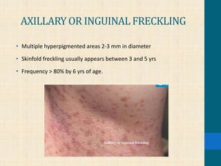 Axillary And Inguinal Freckling