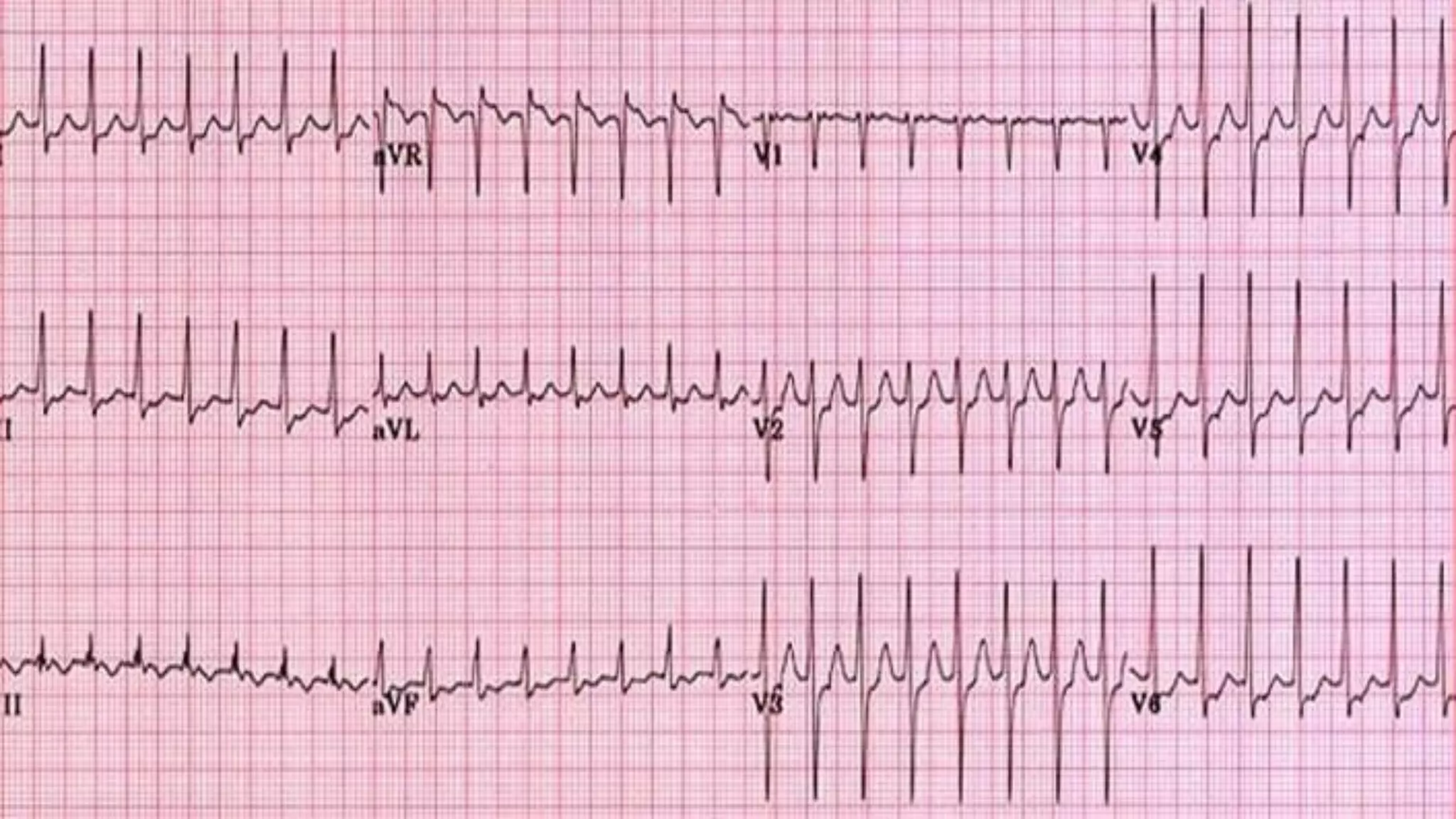 Narrow Complex Tachycardia | PDF