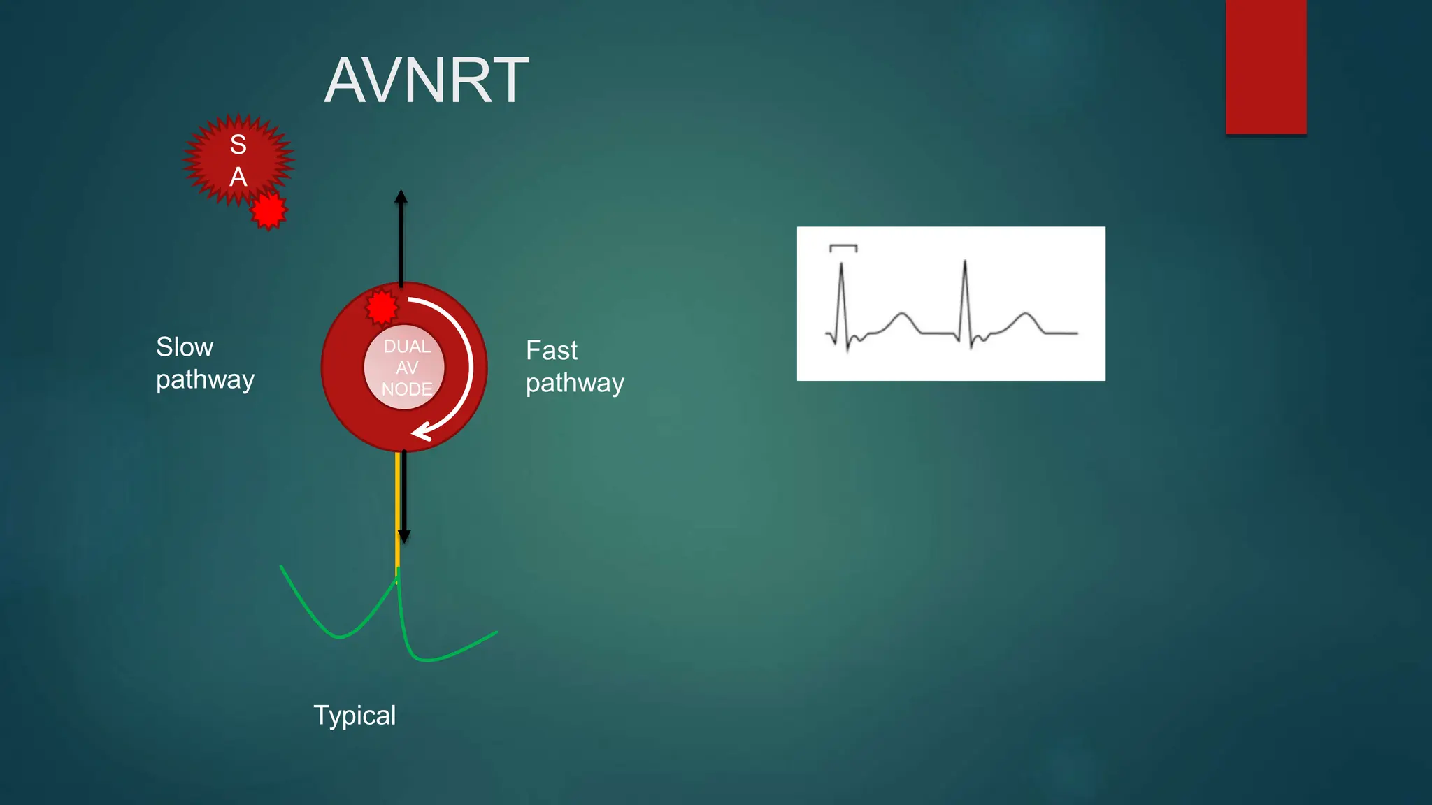 Narrow complex tachycardia/supraventricular tachycardia | PPTX