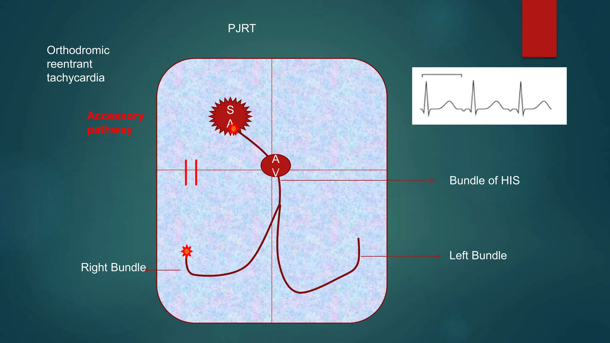 Narrow complex tachycardia/supraventricular tachycardia | PPTX