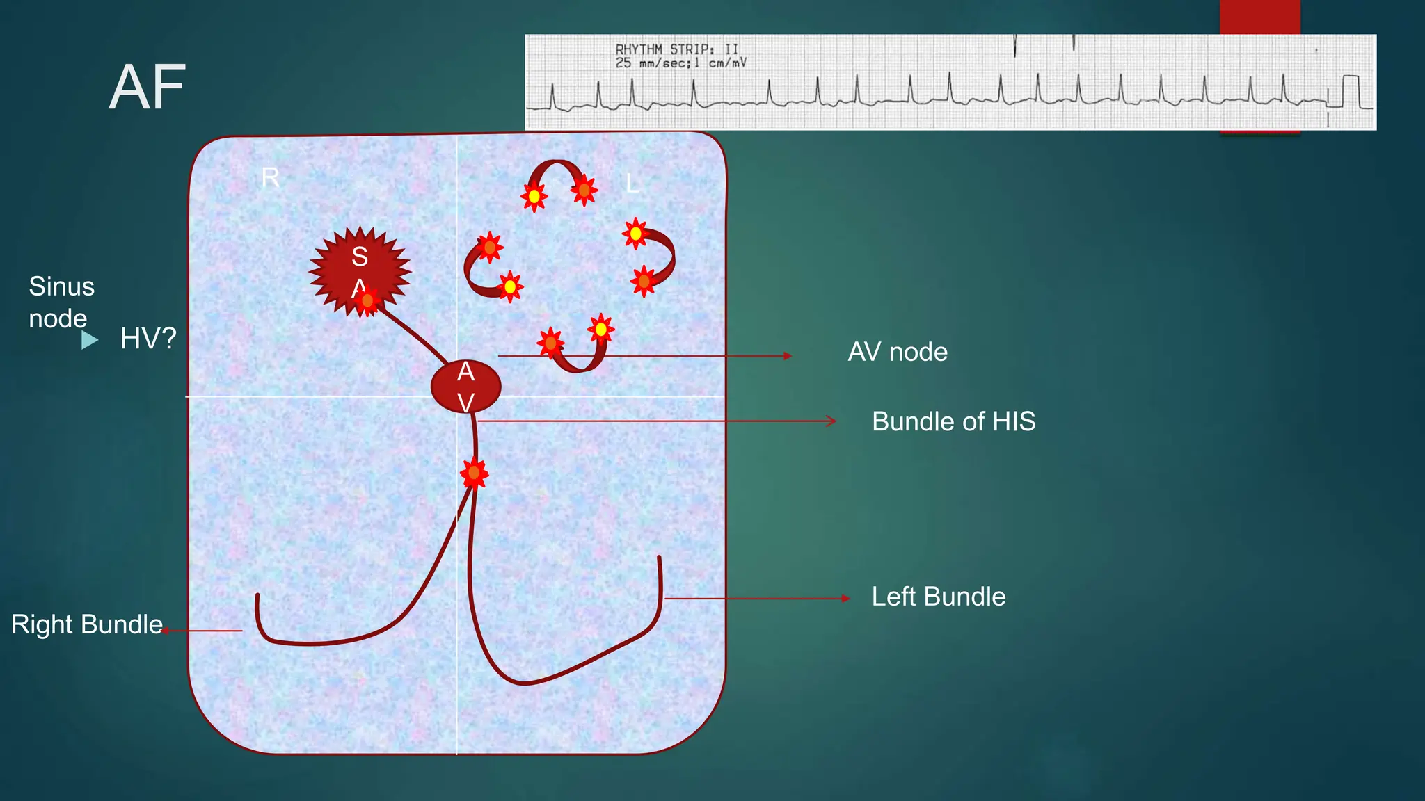 Narrow complex tachycardia/supraventricular tachycardia | PPTX