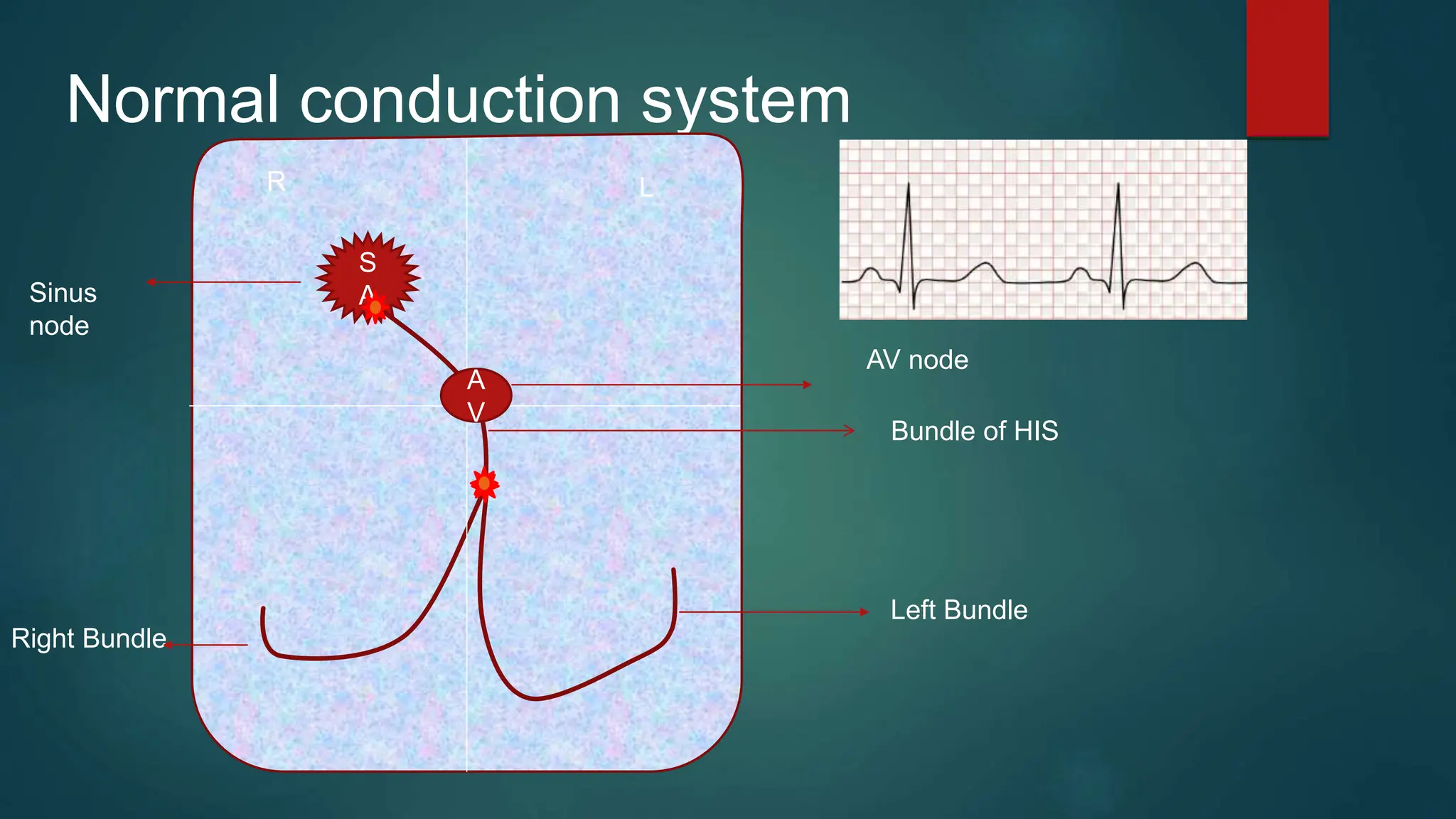 Narrow complex tachycardia/supraventricular tachycardia | PPTX