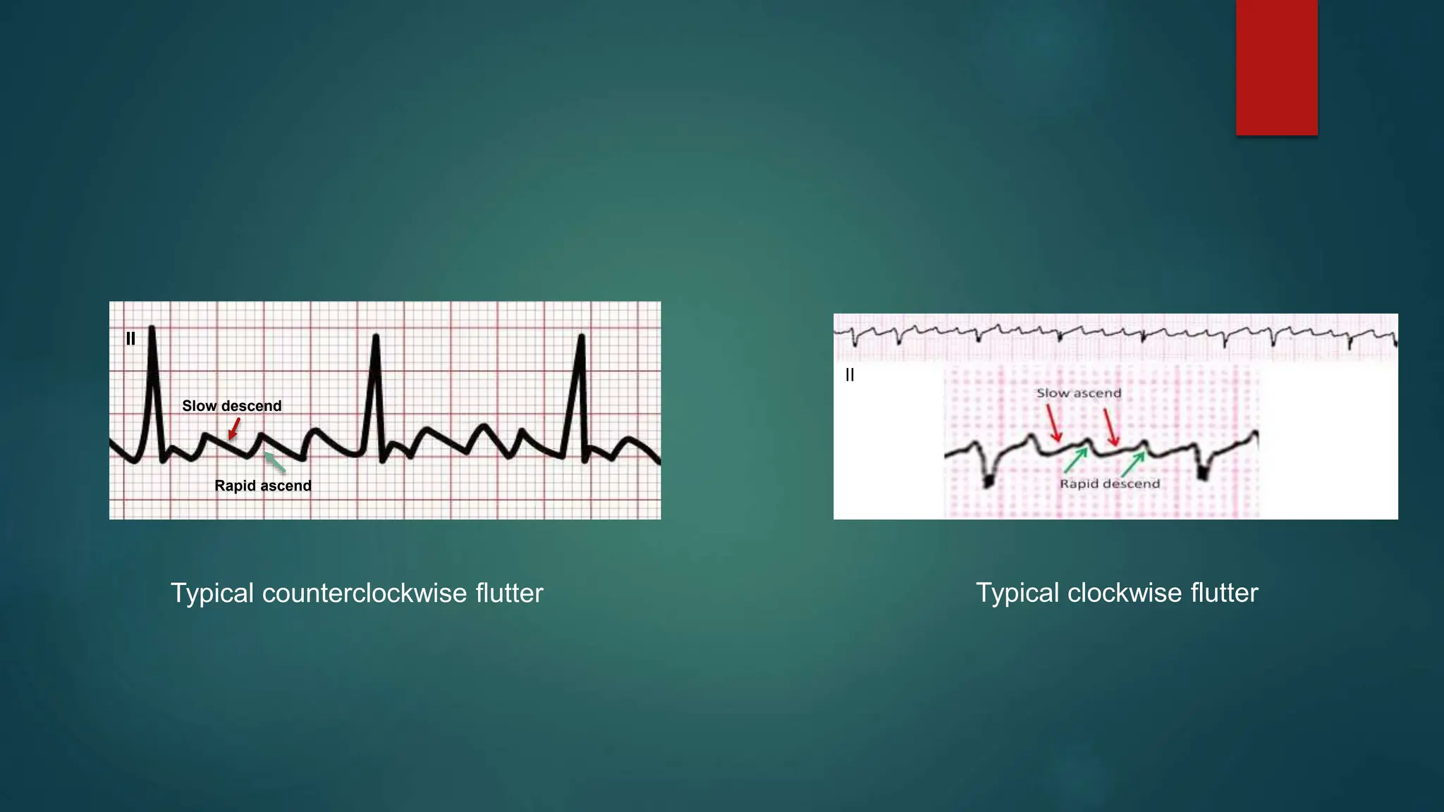 Narrow complex tachycardia/supraventricular tachycardia | PPTX