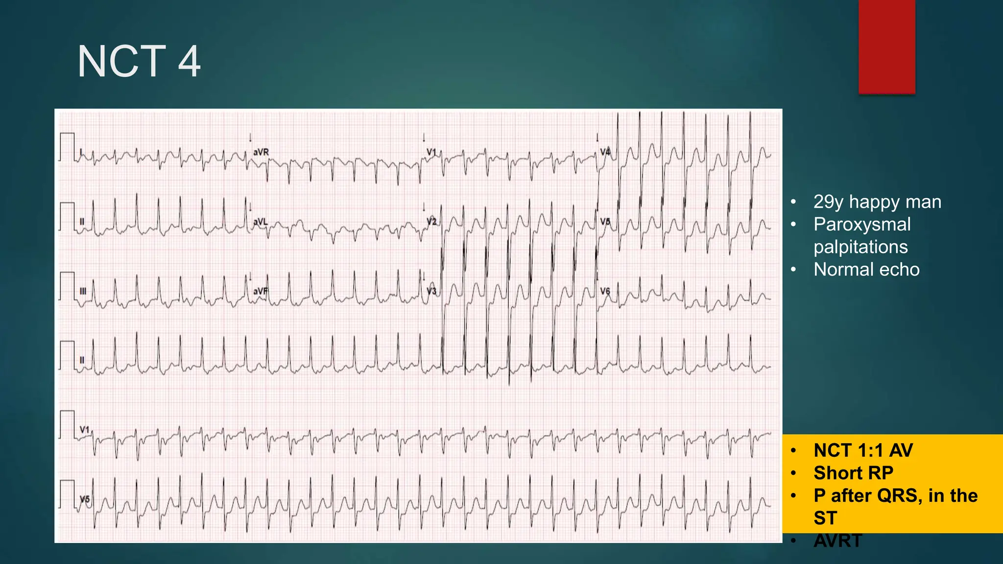 Narrow complex tachycardia/supraventricular tachycardia | PPTX