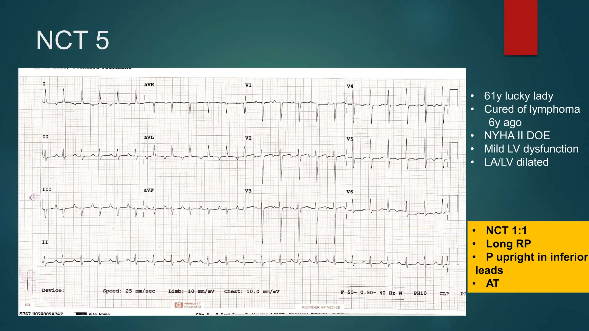 Narrow complex tachycardia/supraventricular tachycardia | PPTX