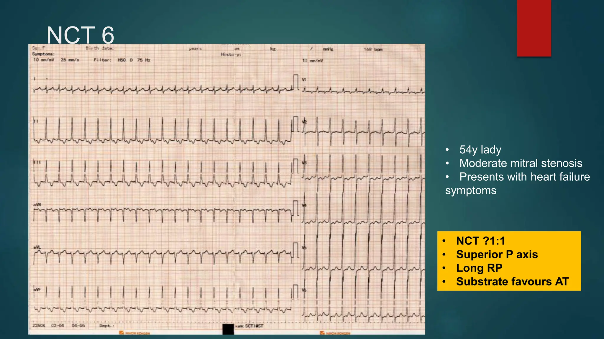 Narrow complex tachycardia/supraventricular tachycardia | PPTX