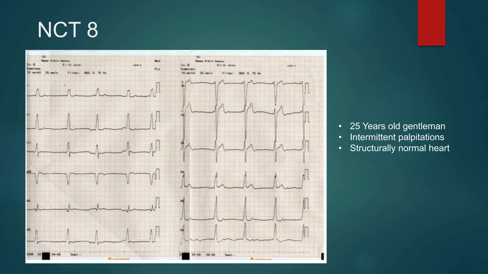 Narrow complex tachycardia/supraventricular tachycardia | PPTX
