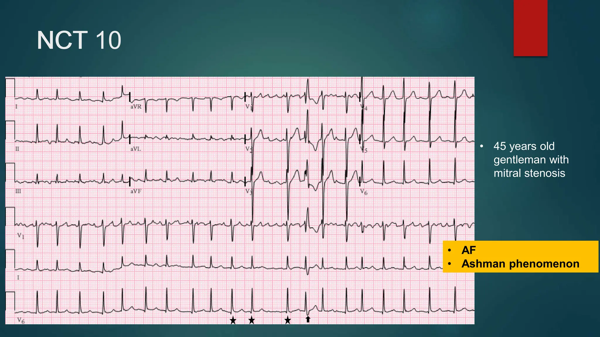 Narrow complex tachycardia/supraventricular tachycardia | PPTX