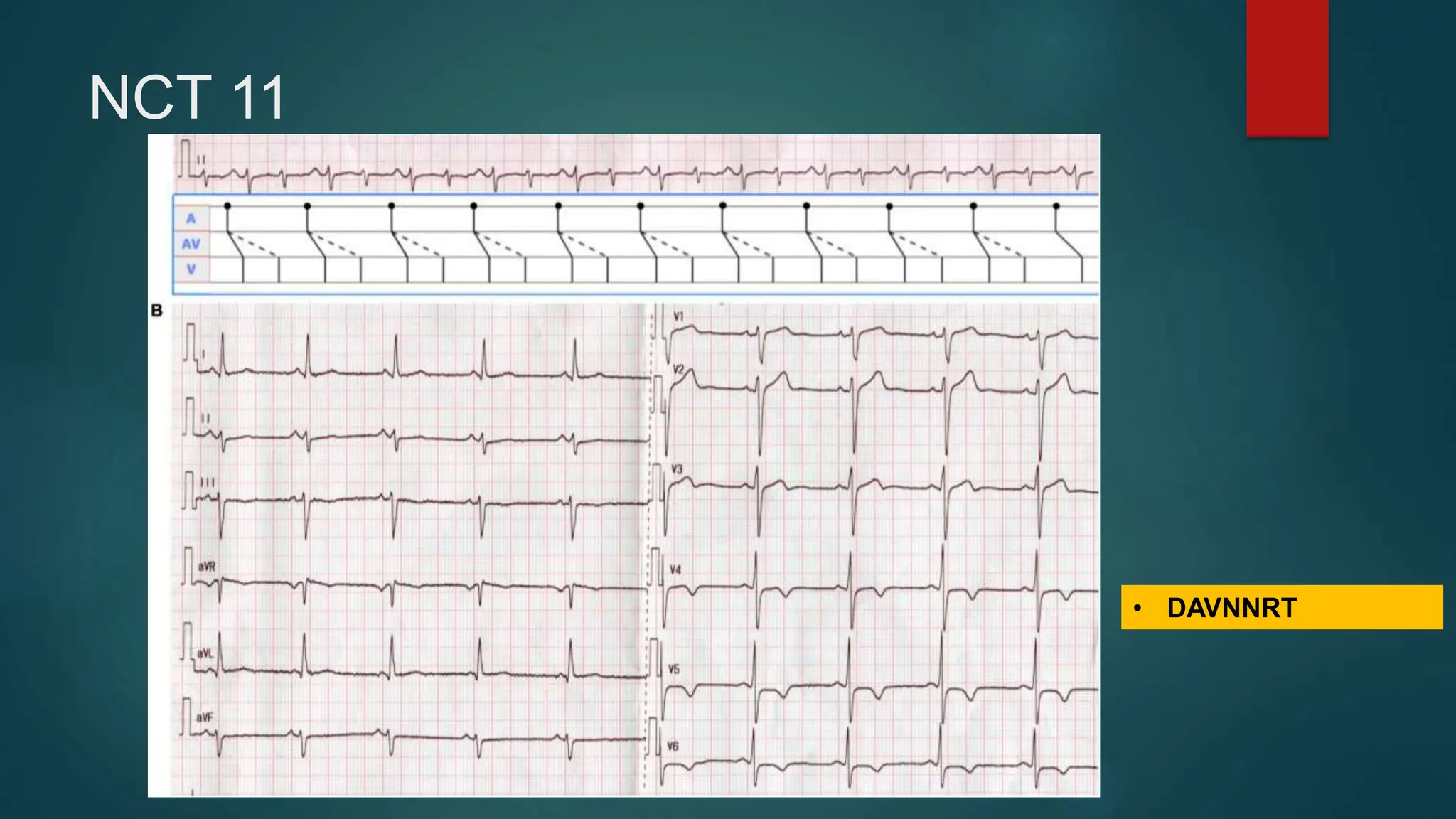 Narrow complex tachycardia/supraventricular tachycardia | PPTX