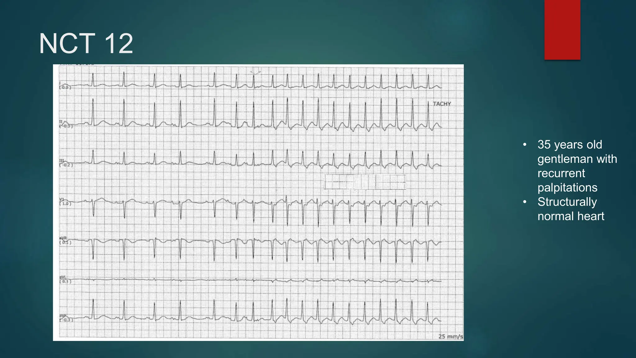 Narrow complex tachycardia/supraventricular tachycardia | PPTX