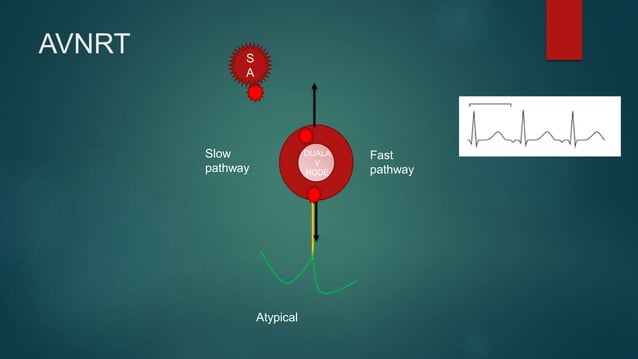 Narrow complex tachycardia/supraventricular tachycardia | PPTX