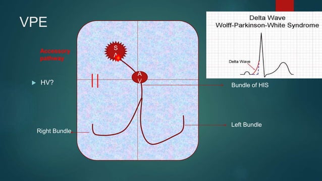 Narrow complex tachycardia/supraventricular tachycardia | PPTX