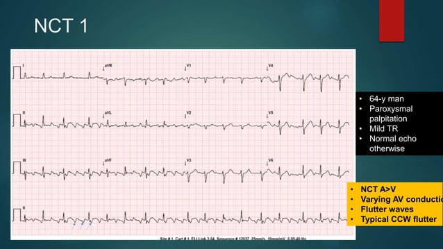 Narrow complex tachycardia/supraventricular tachycardia | PPTX