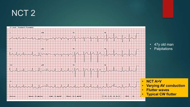 Narrow complex tachycardia/supraventricular tachycardia | PPTX