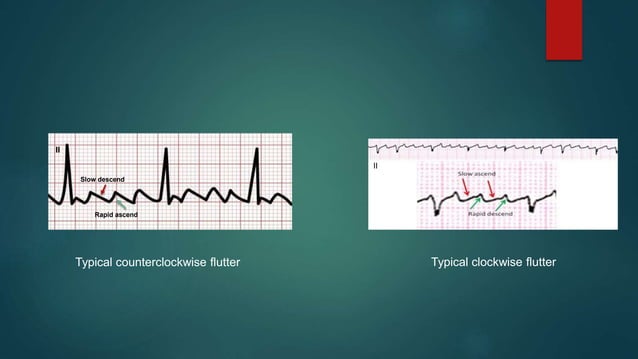 Narrow complex tachycardia/supraventricular tachycardia | PPTX