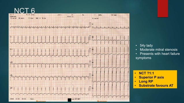 Narrow complex tachycardia/supraventricular tachycardia | PPTX