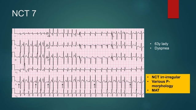 Narrow complex tachycardia/supraventricular tachycardia | PPTX