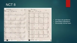 Narrow complex tachycardia/supraventricular tachycardia | PPTX