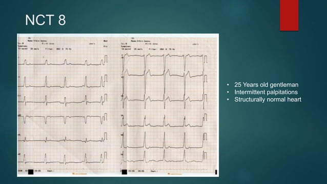 Narrow complex tachycardia/supraventricular tachycardia | PPTX
