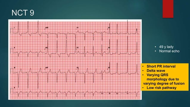 Narrow complex tachycardia/supraventricular tachycardia | PPTX