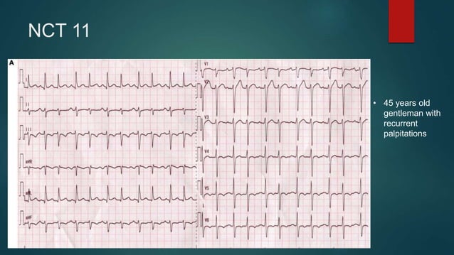 Narrow complex tachycardia/supraventricular tachycardia | PPTX