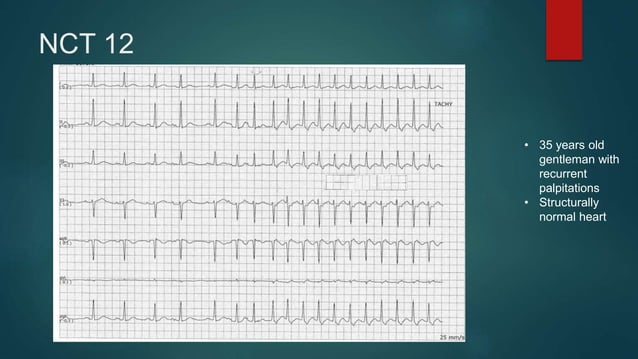 Narrow complex tachycardia/supraventricular tachycardia | PPTX