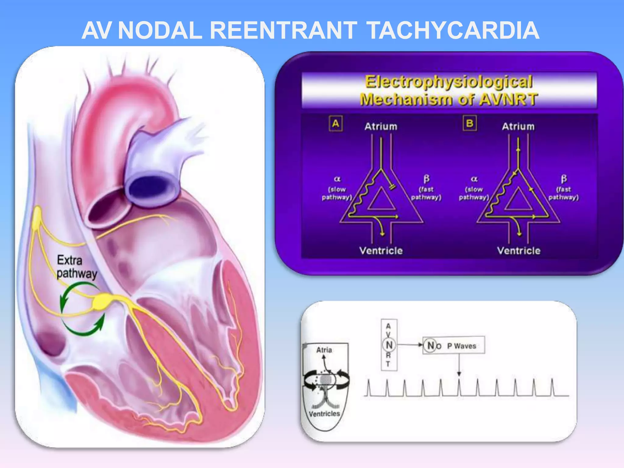 approach to narrow comlex tachycardia | PPT