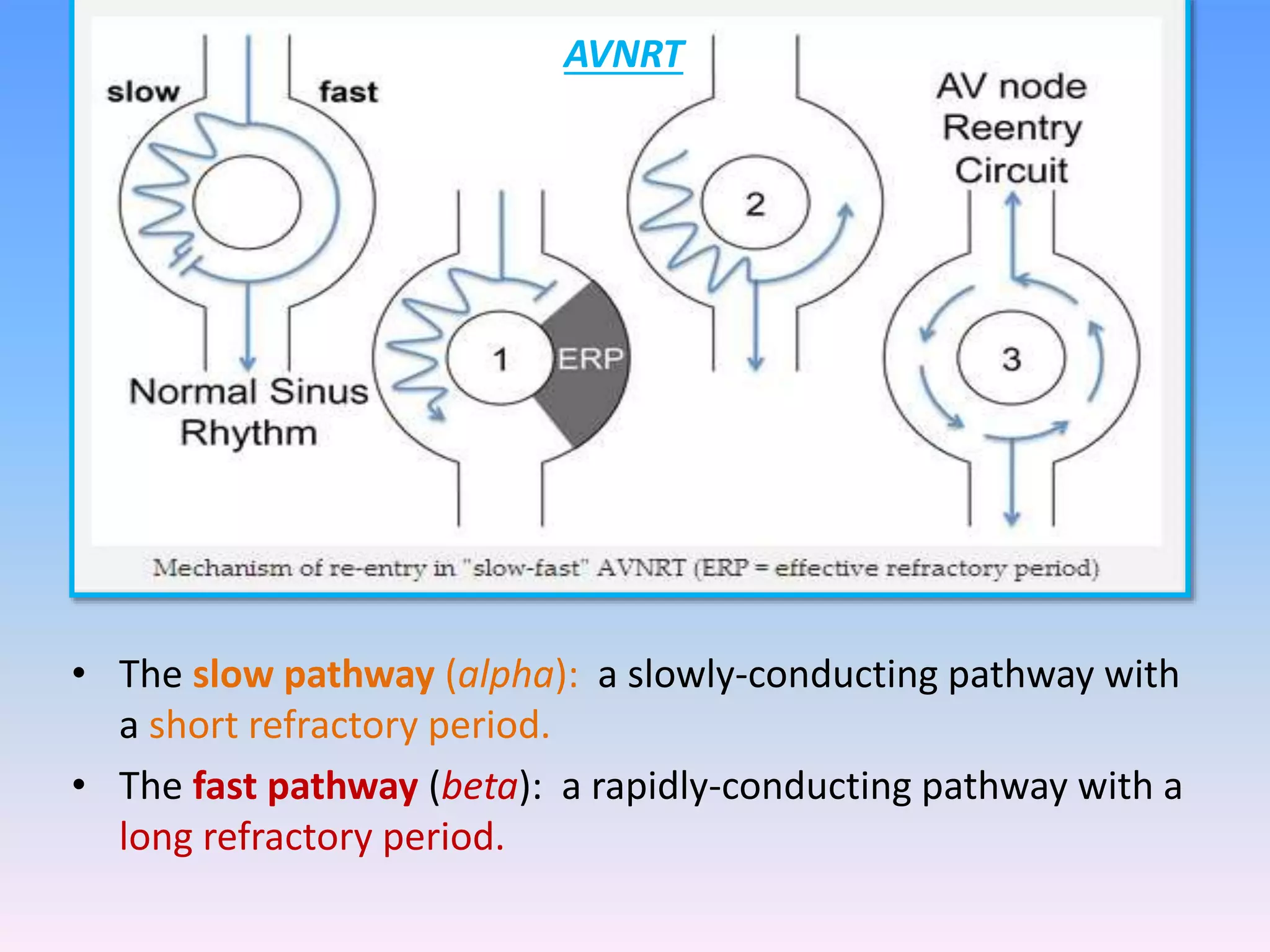 approach to narrow comlex tachycardia | PPT