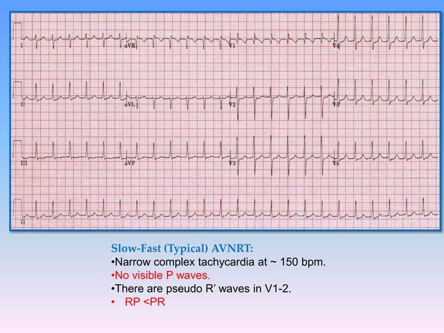 approach to narrow comlex tachycardia | PPT