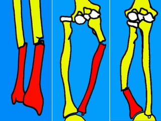 NCT_Gay 2 xuong cang tay.pdf fdsfqw4erfee | PPT