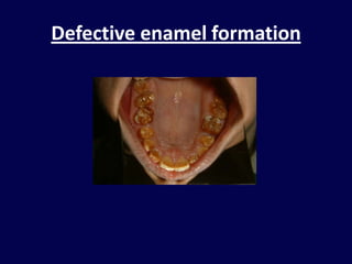 Non-carious tooth substance loss | PPTX